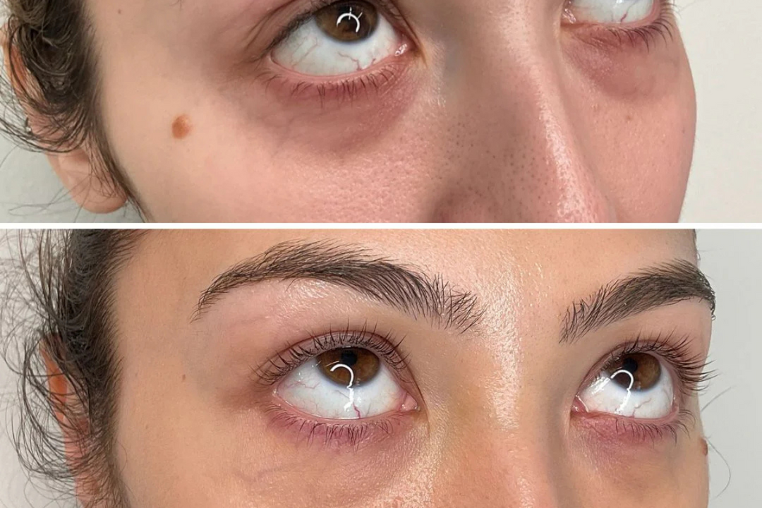 PRF Under Eyes: How It Can Reduce Dark Circles & Rejuvenate Your Skin ...