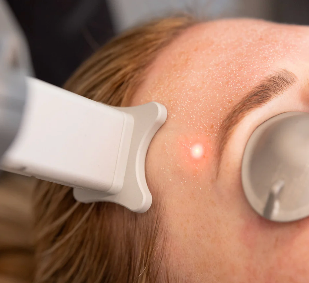 Helix Laser Near Me: What It Is and How It Works – NM Aesthetics Wellness