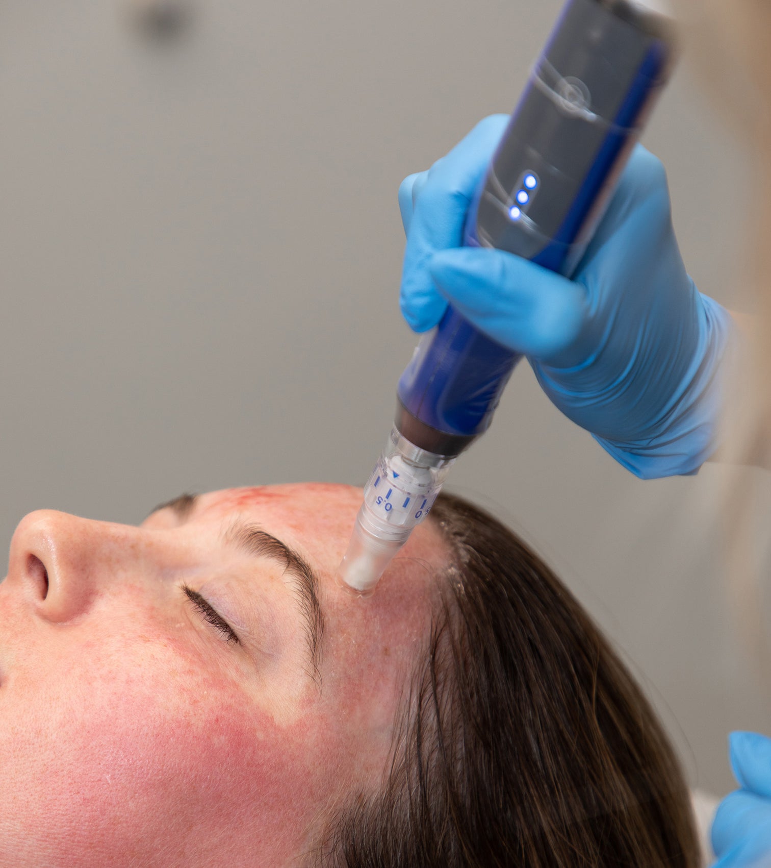 SkinPen Microneedling Treatment in Arlington & Northern Virginia – NM ...